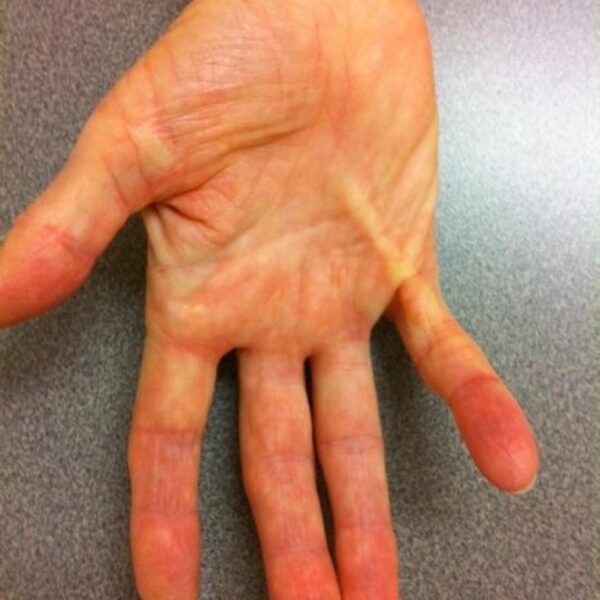Post-op rehabilitation | Merivale Hand Clinic