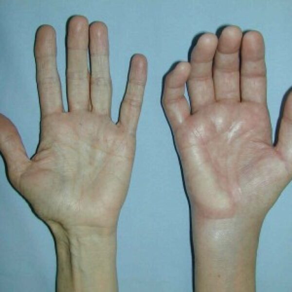 Pain and CRPS | Merivale Hand Clinic