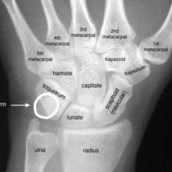 Resource hub | Page 4 of 7 | Merivale Hand Clinic