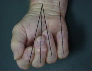 Resource hub | Page 4 of 7 | Merivale Hand Clinic