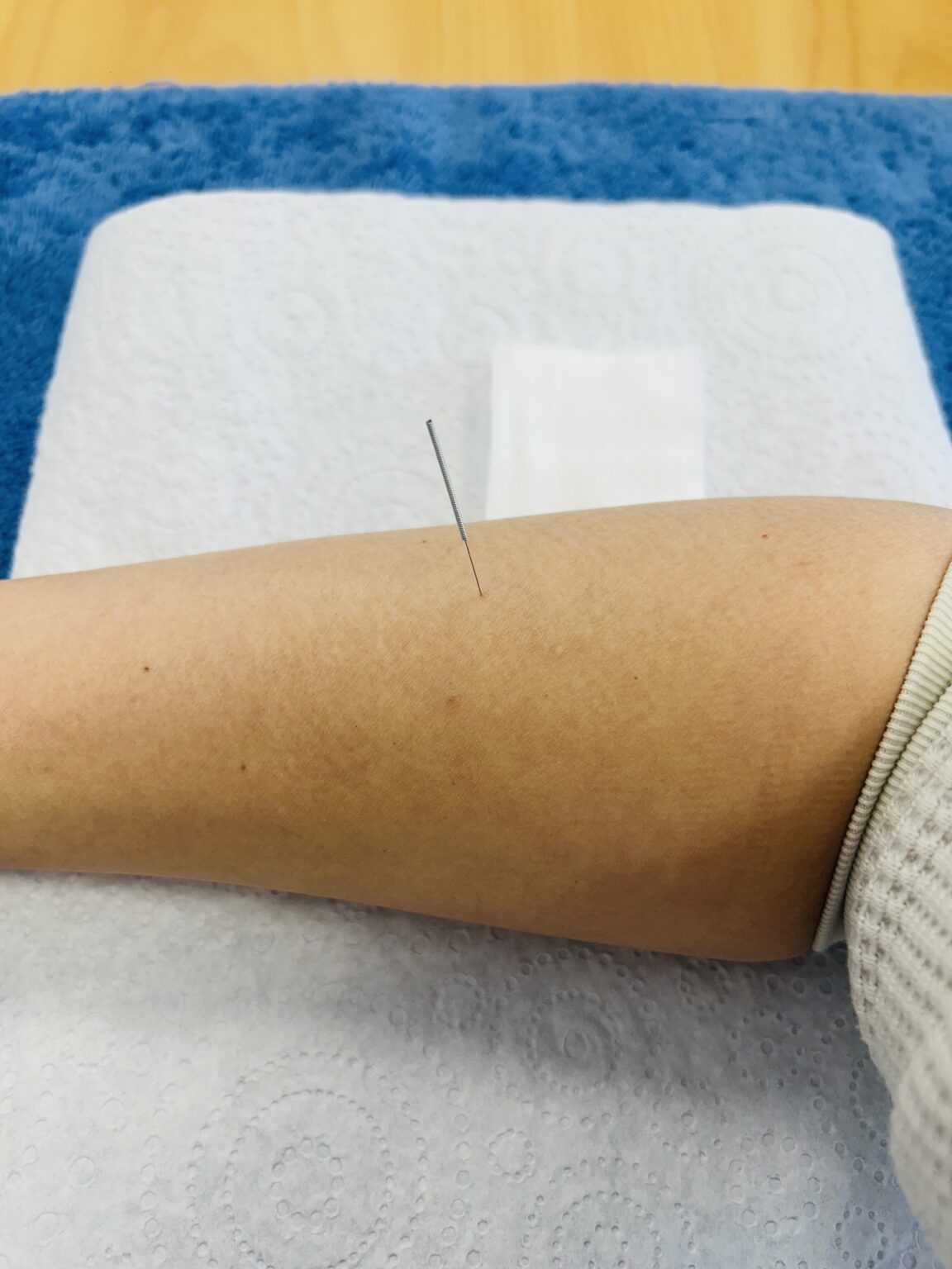 Dry Needling for Hand Pain: A Modern Approach in Hand Rehabilitation ...